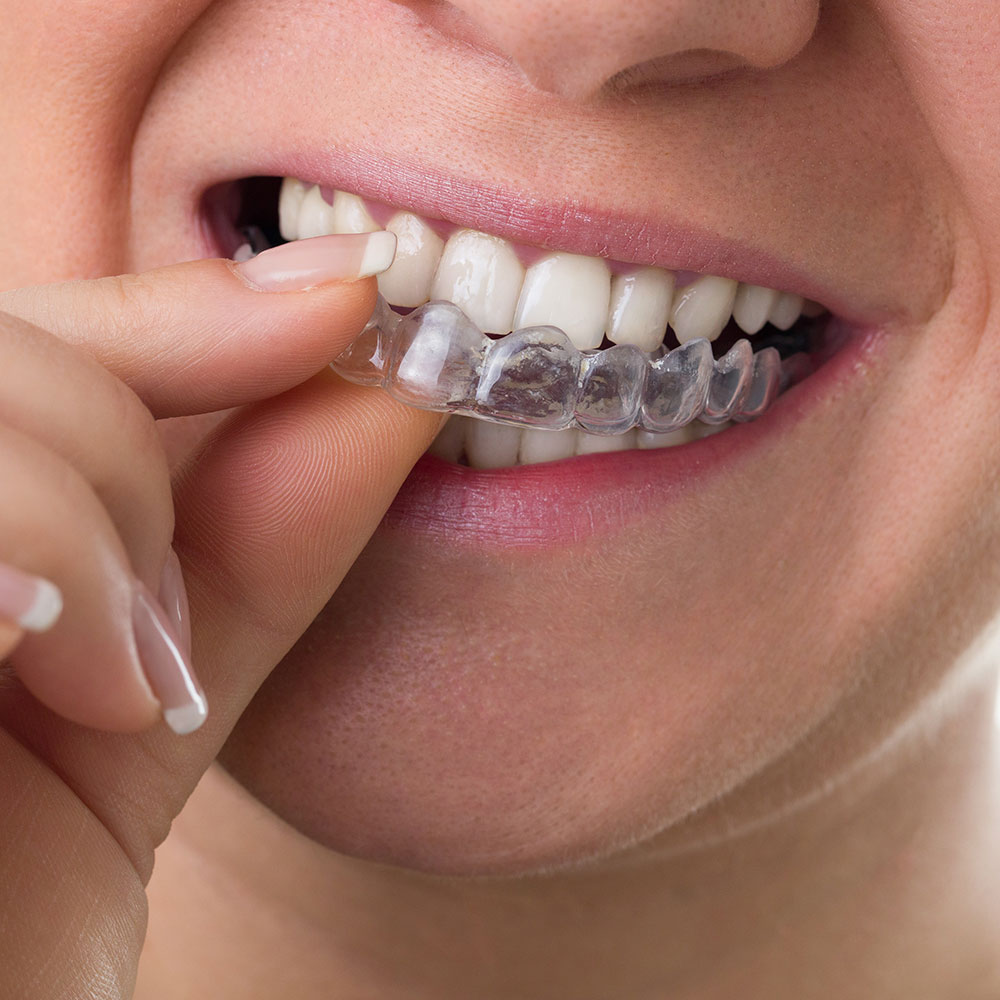 Patient-Removing-Invisalign | Malahide Dental Care Tel:01 8455666 Dr R ...